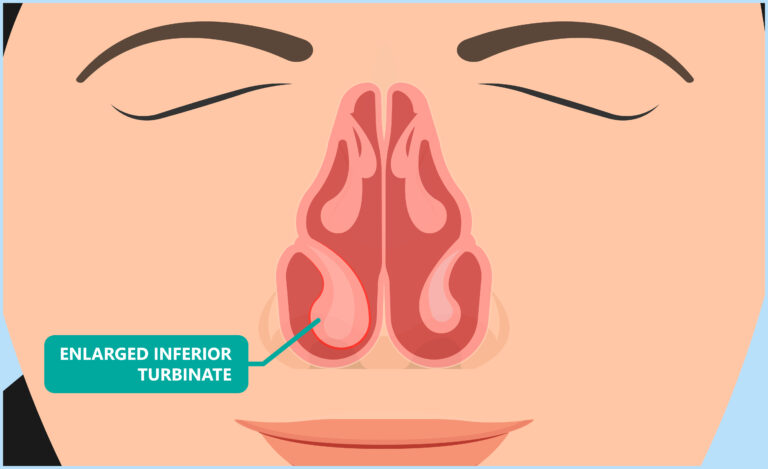 What Happens During Turbinate Reduction? | Indianapolis Sinus Center