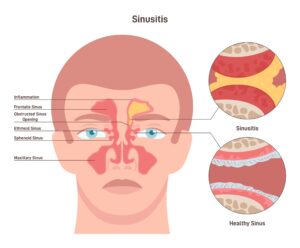 Can Chronic Sinus Infections Come Back? | Indianapolis Sinus Center