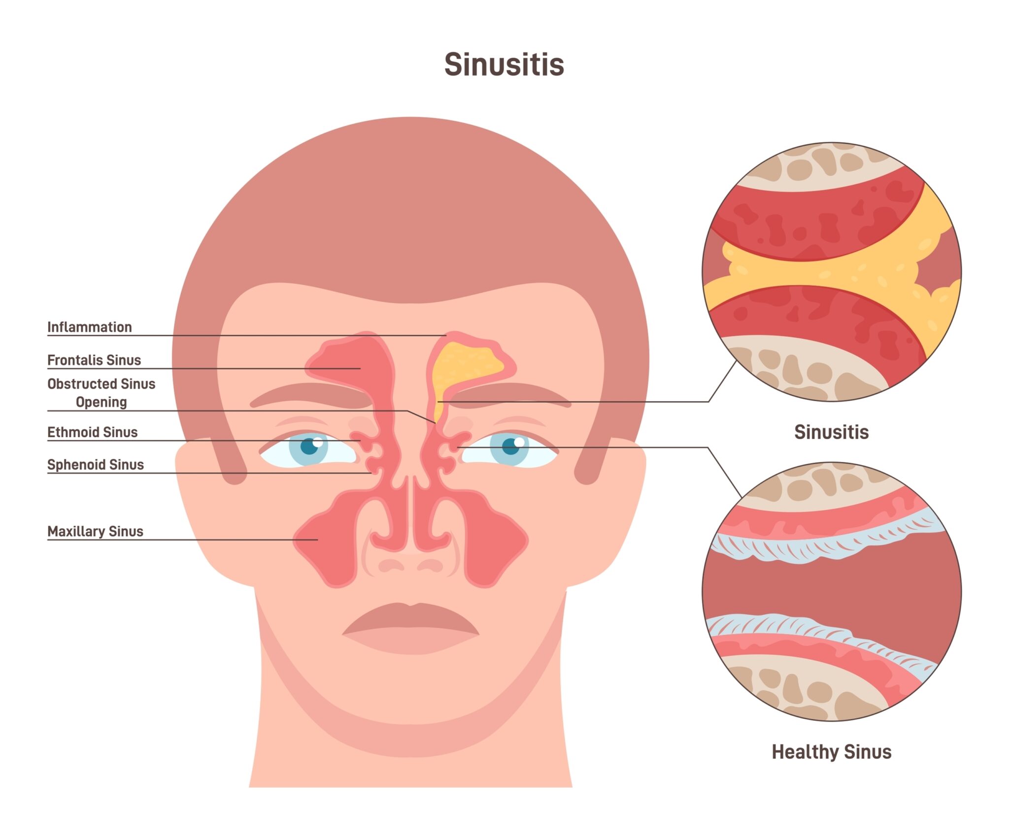 Can Chronic Sinus Infections Come Back? | Indianapolis Sinus Center